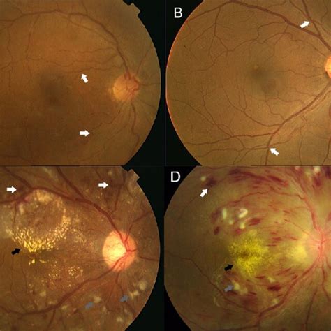 Hr In Different Stages According To Wong And Mitchell Classification