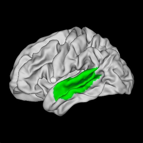 Temporal Cortex Areas 20 21 22 Radiology Key