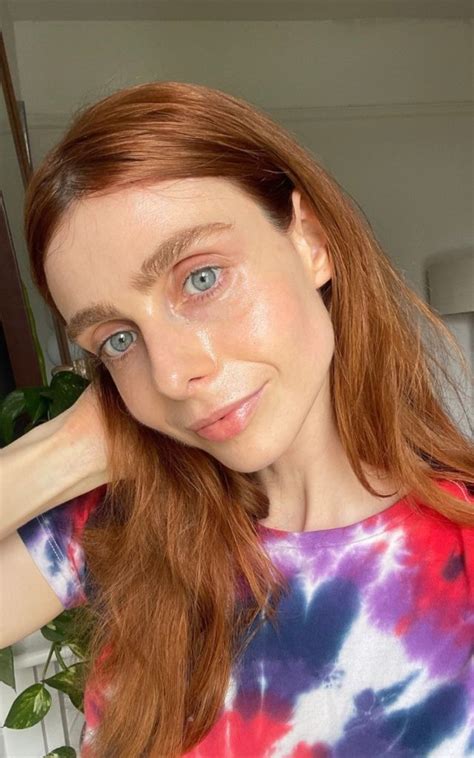 Profhilo Review A Beauty Editor S Before And After Results