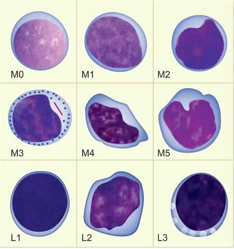 Morphology Of Blast Cells In Acute Myelogenous And Acute Lymphoid
