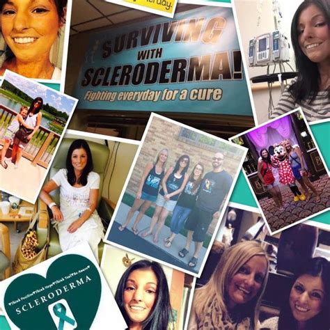 Looking Back On My Years With Scleroderma