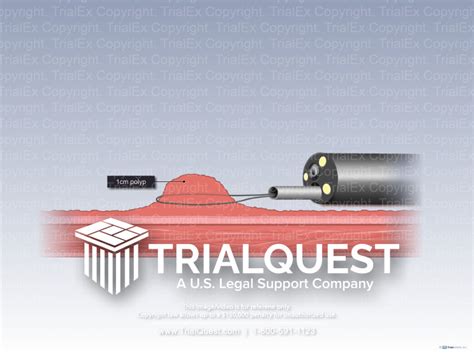 Polyp Resection Trialquest Inc