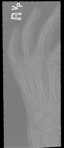 Bone Fracture Detection Object Detection Model V4 V4 By Veda