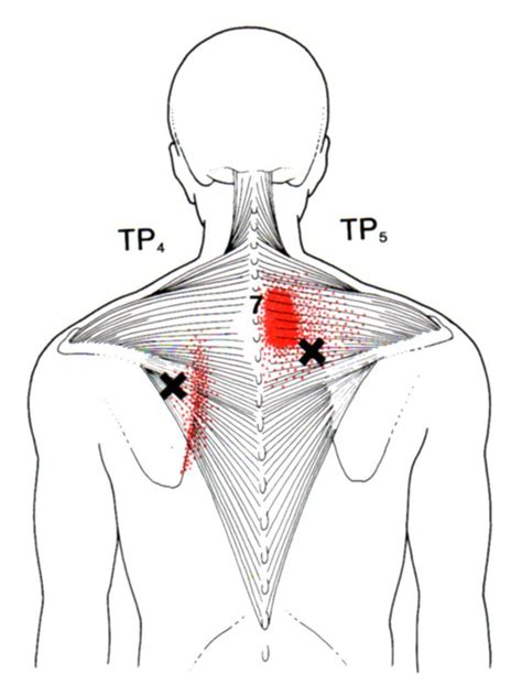 Pin Auf Health Myofascial Release Trigger Point