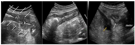 Figures Representing Crohn Ileitis The Walls Are Diffusely Thickened