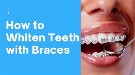 How To Whiten Your Teeth With Braces At Zane Hodge Blog