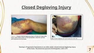 Revisi Ppt Referat Open Degloving Injurypptx