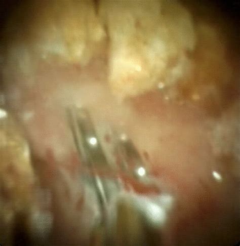 Cholangioscopy Showing Two Surgical Clips Migrated Into The Choledochal