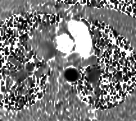 Calculation Of The Phase Accumulation In Mri Pulse Sequence