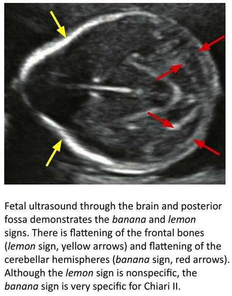 Fetal Ultrasound Lemon Sign