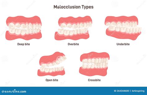 Malocclusion Types Set Human Crooked Teeth Misalignment Or Incorrect