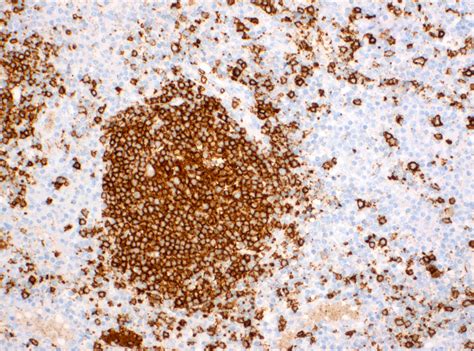 Pathology Outlines Cd20