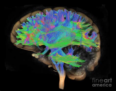 Brain Fiber Tractography Image 8 Photograph By Scott Camazine Pixels