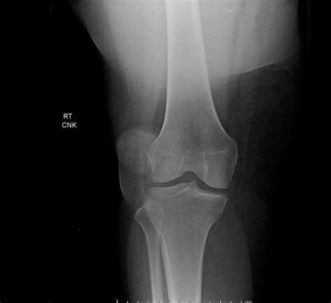 Image Patellar Dislocation X Ray Msd Manual Professional Edition