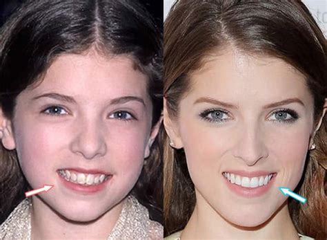 Did Anna Kendrick Get Surgery To Look Hot