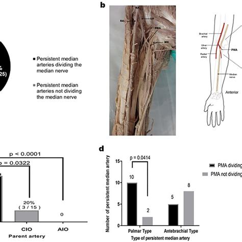 Division Of The Median Nerve By The Persistent Median Artery A