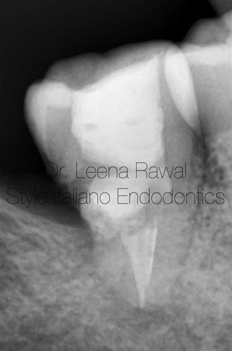 Internal Root Resorption In Permanent Mandibular Molar A Rare Entity