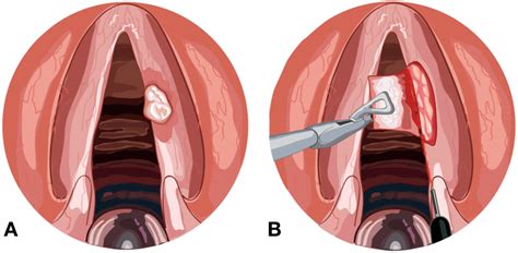 Bleeding Vocal Cords