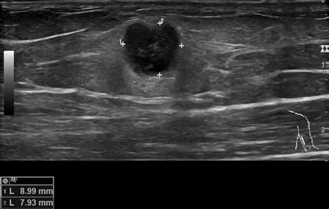Epitrochlear Nodes