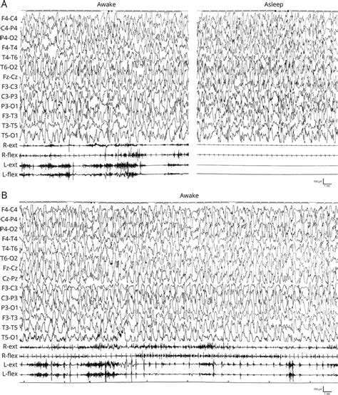 Patient 1 Myoclonic Status Download Scientific Diagram