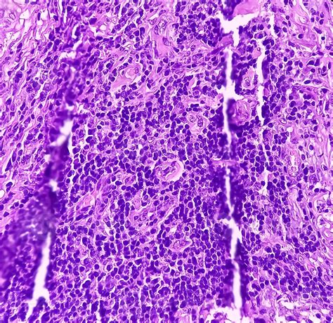Thyroid Cancer Microscopic Image Of Follicular Neoplasm Malignant Neoplasm Of Atypical Thyroid