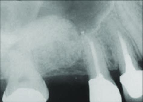 Post Operative Radiograph Showing Graft Containment Download Scientific Diagram