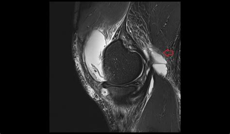 Mri Knee Pathologies Radiology Articles On Knee Pathologies