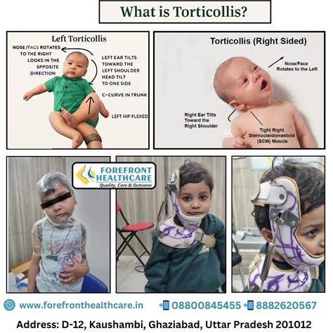 What Is Torticollis Causes Symptoms And Treatment
