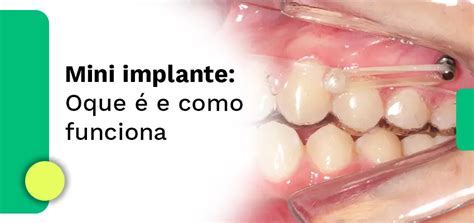 Mini Implante O Que é E Como Funciona