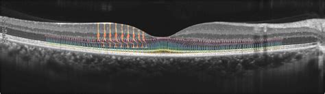 Cross Sectional High Resolution Oct B Scan Of A Healthy 29 Year Old Man Download Scientific