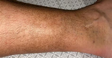 Discoloration Of Lower Leg Album On Imgur