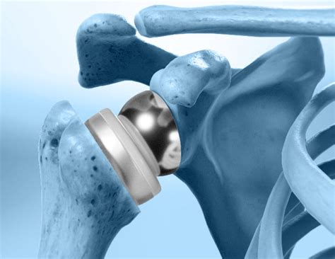 Advancements In Shoulder Replacement Surgery A Look Into Dr Matthew Griffiths Expertise