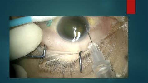 Posterior Uveitis Infective Causes Ophthalmology Pptx