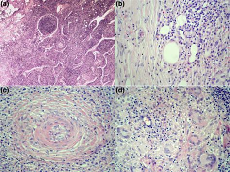 Does Syphilis Cause Swollen Lymph Nodes