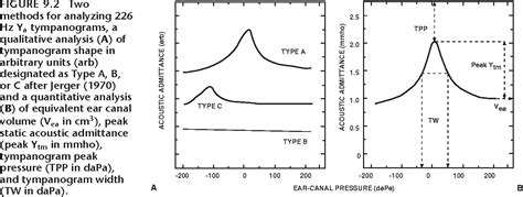 Tympanometry Curves At Judy Acosta Blog
