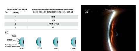 Técnica De Van Herick Sencilla Pero Valiosa Franja Ocular