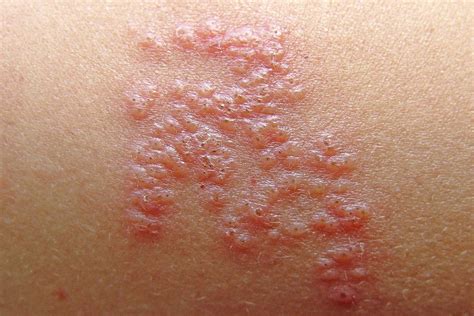 The Limited Usage Of Shingles Vaccine Due To The Pandemics Impact On