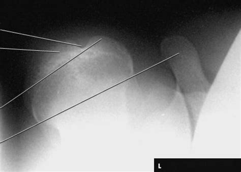 Tangential Projection Fisk Method Xray Labeled With Criteria Diagram Quizlet