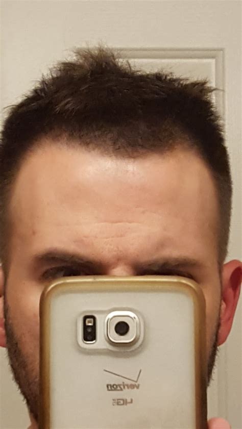 Scalp Threading With Polydioxanone Monofilament Threads A Novel