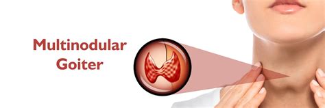 Multinodular Goiter Causes Symptoms Treatment Strategies