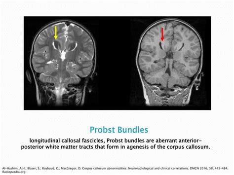 Agenesis Corpus Callosum Ppt