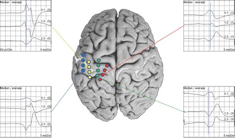 Intraoperative Neuromonitoring Neurologic Clinics