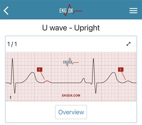 1 Lets Talk About U Waves Cardiotwitter The U Wave Is A Deflection Usually Small