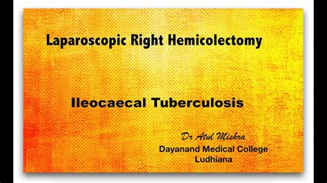 𝗟𝗮𝗽𝗮𝗿𝗼𝘀𝗰𝗼𝗽𝗶𝗰 𝗥𝗶𝗴𝗵𝘁 𝗛𝗲𝗺𝗶𝗰𝗼𝗹𝗲𝗰𝘁𝗼𝗺𝘆 𝗗𝗿 𝗔𝘁𝘂𝗹 𝗠𝗶𝘀𝗵𝗿𝗮 𝗟𝘂𝗱𝗵𝗶𝗮𝗻𝗮 Youtube