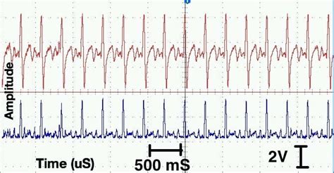 R Wave Detection Using 180 Bpm Ecg Signal Download Scientific Diagram