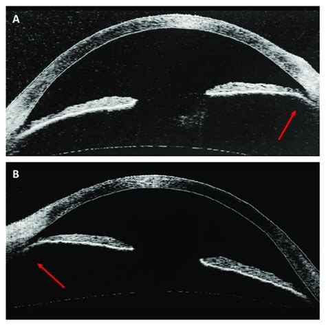 Grading Of Angle Recession 61 Download Scientific Diagram