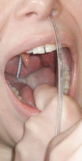 Intubations Image 747593 ThisVid Tube