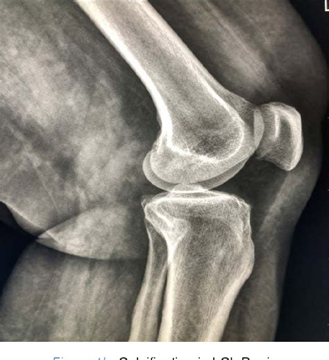 Figure 1 From Arthroscopic Excision Of Calcification In Lateral Collateral Ligament Of Knee With