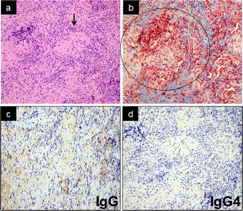 Histology Of A Lung Biopsy Specimen By Bronchoscopy A He Stain 200× B