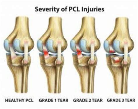 Pcl Tear A Orthopaedics And Sports Med Center New Delhi